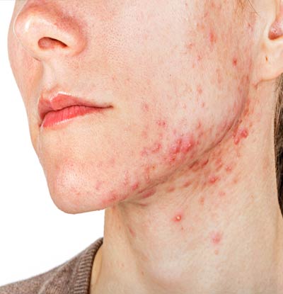 Pimple Popping - Should I Pop My Pimple - Is It Okay To Pop A Pimple